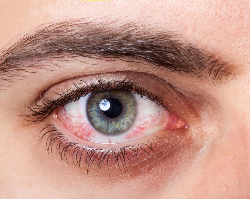 Can Surgery Help Chronic Dry Eye? | Dr. Malena Amato